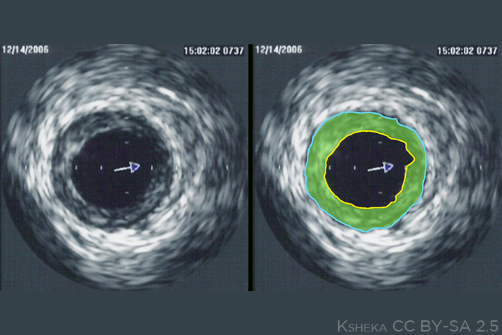 Important Article Addresses Recent Cardiology Confusion on CAC Scan ...