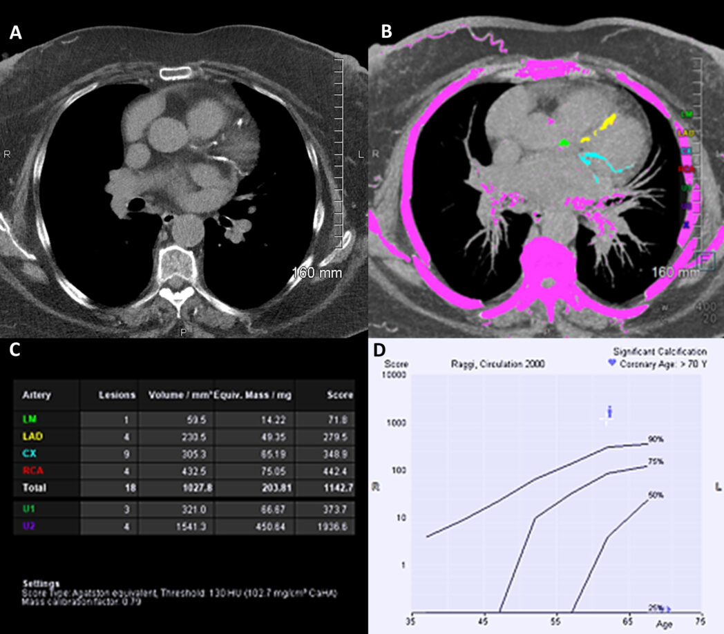 Ep130 A Super-High Calcium Score? How to Deal with It! — The Fat Emperor